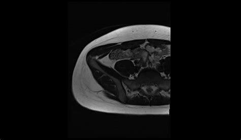 Appendix Mri T2 Tse Axial Images