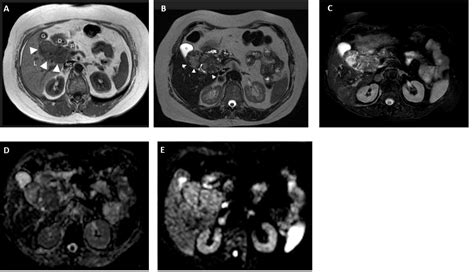 Frontiers Hepatic Incidentaloma An Asymptomatic Ectopic Thyroid Tissue