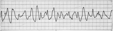 Ventricular Flutter Ecg