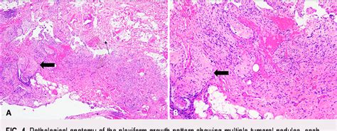 Figure 1 From The Recurrent Plexiform Neurofibroma Of The Scalp In Neurofibromatosis Type 1