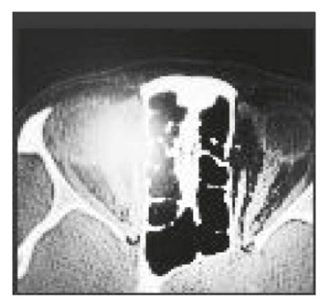 Sample Image Of Brain Tumor2 A Original Image B Yang Et Al 6 Download Scientific