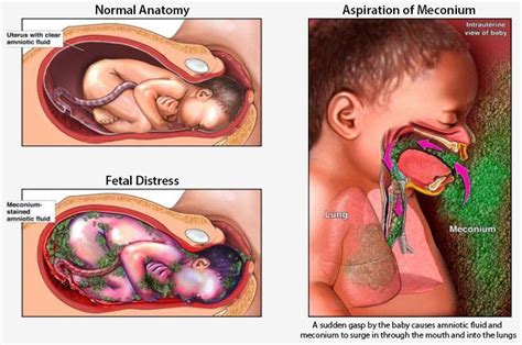 Meconium Aspiration Syndrome Meconium Stained Amniotic Fluid