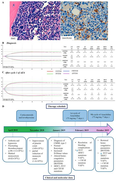 Germline Csf3r Variant In Chronic Myelomonocytic Leukemia Linking