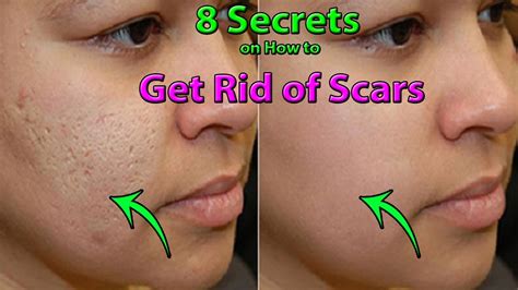 How To Get Rid Of White Scars Step By Step Guide Taft Independent