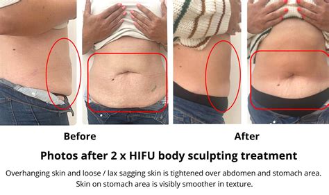 Hifu Body Sculpting Achieve Toned Abs And A Flatter Stomach