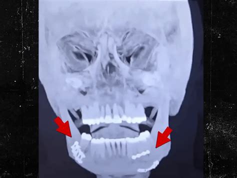 Jake Paul Had Teeth Removed After Anthony Joshua Broke His Jaw Yahoo