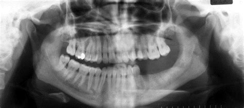 Bilateral Tonsillolithiasis A Case Report Oral Surgery Oral