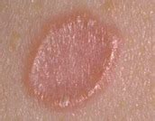 115 Skin Lesions Flashcards Quizlet