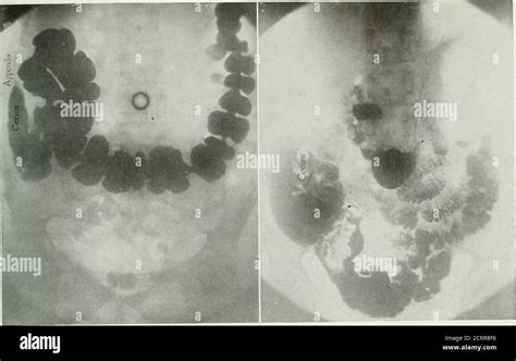 The American Journal Of Roentgenology Radium Therapy And Nuclear