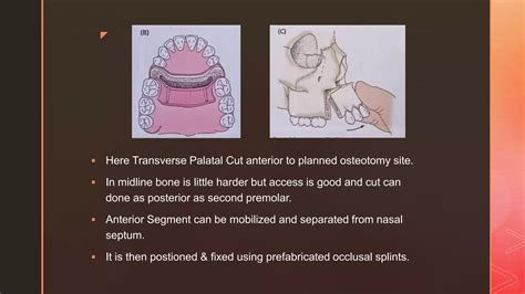 Anterior Segmental Maxillary Osteotomypptx