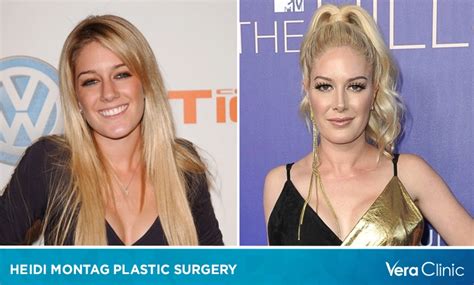 Heidi Montag Plastic Surgeries Before And After