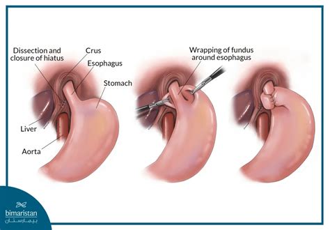 Esophageal Surgery Indications Procedure And Success Rates