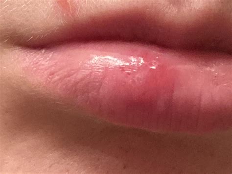 Herpes Blisters Pop