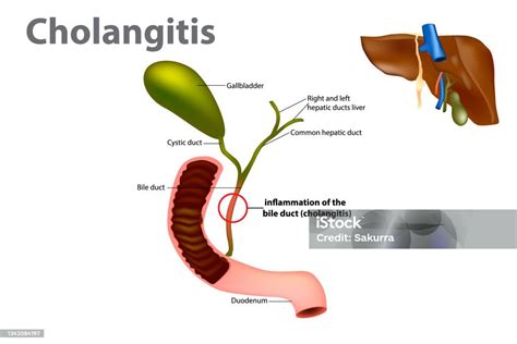 Ascending Cholangitis Also Known As Acute Cholangitis Or Simply