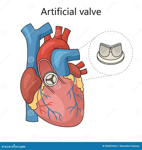 Artificial Heart Valve In Heart Medical Science Stock Vector Illustration Of Medicine Scheme