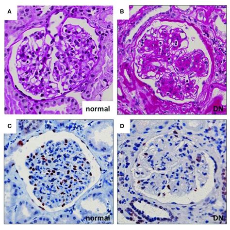 Glomerular Histopathology In Dn A B Diabetic Glomeruli Present