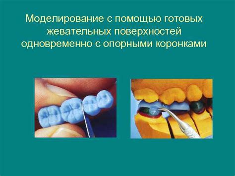 Изготовление цельнолитых протезов. Литые коронки