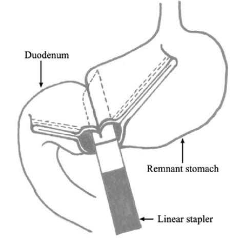 Schematic Illustration For Uncut Roux En Y Gastrojejunostomy In Totally Download Scientific