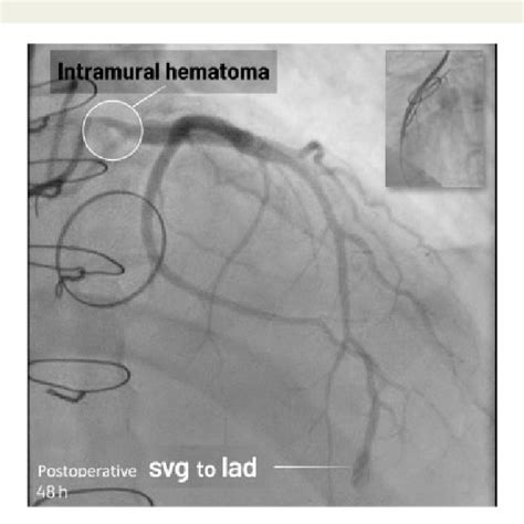 Coronary Angiography Performed H After The Operation The Angiogram Download Scientific