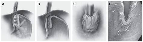 Endoscopy And Antireflux Surgery A Technical Review Of Pre And