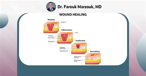 Deep Open Wound Healing Time How Long To Heal Lacerations Tdbdy