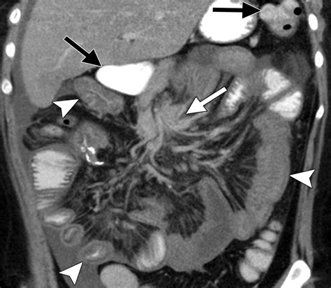 Pearls Pitfalls And Conditions That Mimic Mesenteric Ischemia At Ct Radiographics