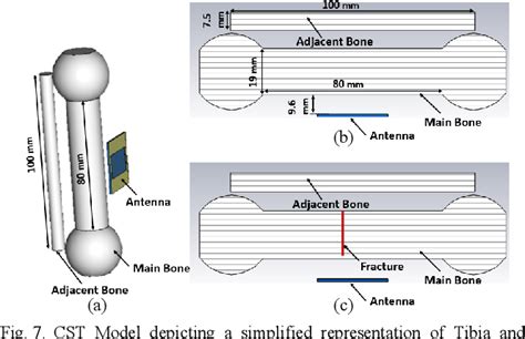 Figure 1 From Fracture Detection Using A Wideband Wearable Monopole Antenna Based On Microwave