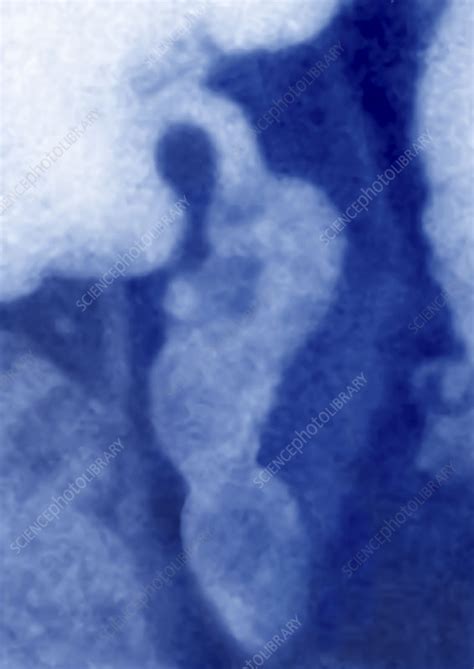Appendicitis X Ray Stock Image C002 0589 Science Photo Library