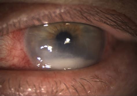 Bacterial Keratitis