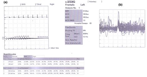a the rns shows incremental amplitude response b single fibre