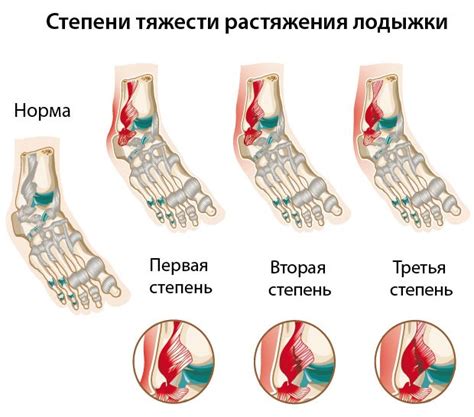 Спортивна травма