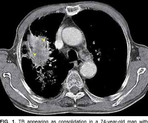 Figure 1 From Pulmonary Tuberculosis Confirmed By Percutaneous