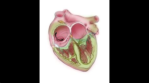 Ablation Of Cavotricuspid Isthmus Dependent Atrial Flutter Youtube