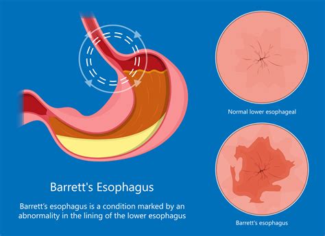 Understanding Barretts Esophagus Gastrointestinal Diseases Inc