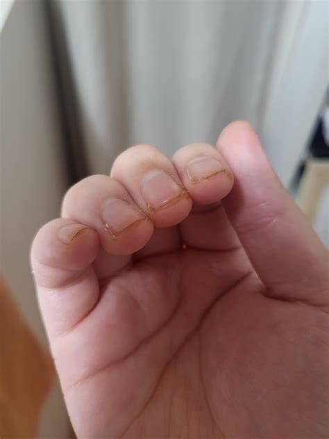 손톱밑에 살 색 지식in