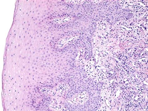 Overall Image Of The Gingival Mucosa Where We Observe The Increase Of