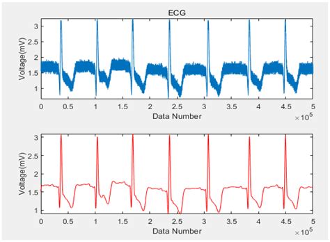 Lightweight Ensemble Network For Detecting Heart Disease Using Ecg Signals