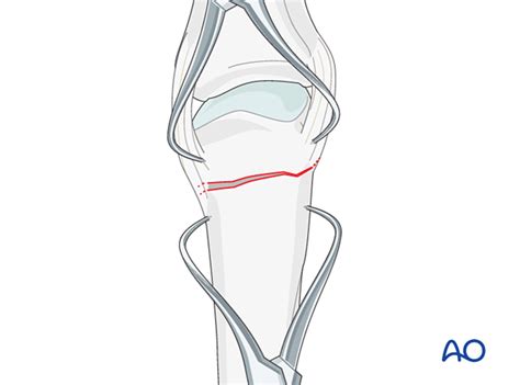 Compression Plating For Extraarticular Fracture Of The Distal End Segment
