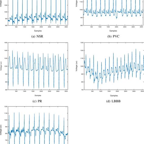 Samples Of The 11th Subband Of Ecg Signals And Its Ceemd From The Five Download Scientific