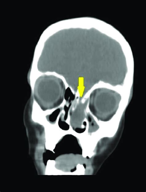 On Coronal Reformated Ct Images A Bony Defect Is Seen On Left Lamina