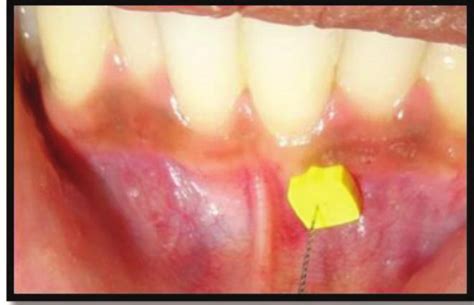 Transgingival Probing