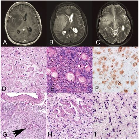 Granular Cell Astrocytoma Has Molecular Genetic Features Overlapping