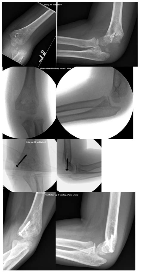 Pediatric Elbow Dislocations And Associated Fractures Pmc