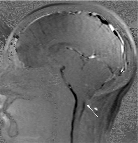 Spontaneous Resolution Of Aberrant Cerebellar Tonsil Movement In A Patient With Improving Chiari