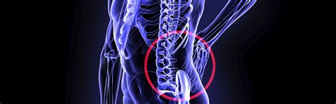 3 Ways To Capture Sciatica Patients For Chiropractic Treatment Pulstar