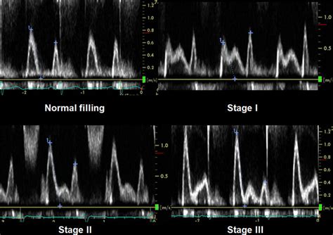 Mitral Inflow Patterns Of Patients With Mid Diastolic L Wave According