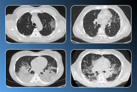 Imaging Of Viral Pneumonia And Its Differentials Berlincaseviewer By Berlinflame Gmbh