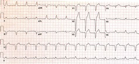 Normal Ecg Vs Heart Attack Ecg