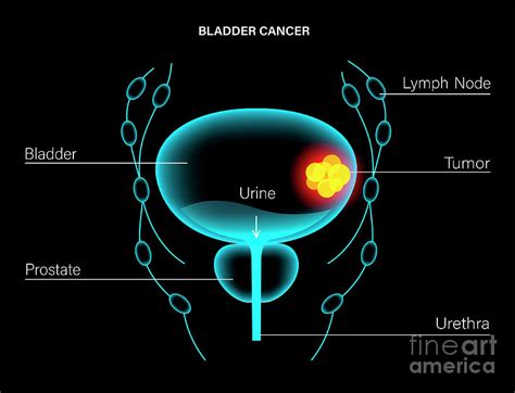 Bladder Cancer Diagram