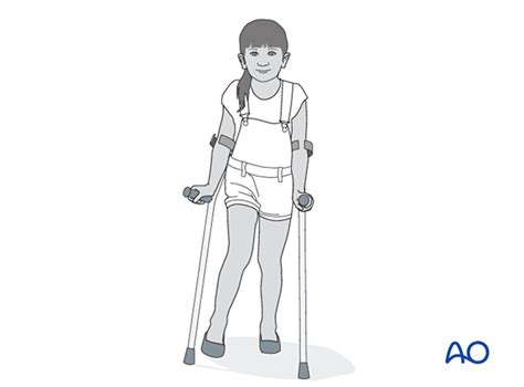 Arthroscopically Assisted Screw Fixation For Avulsion Of The Tibial Spine